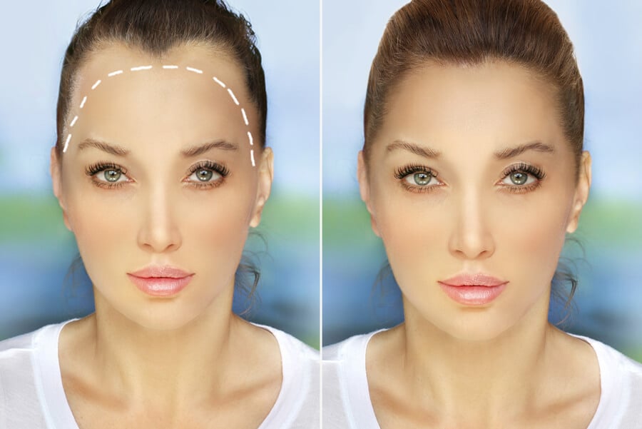 Choosing Confidence: Understanding Forehead Reduction vs. Hair ...